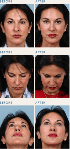 Types of Functional Septorhinoplasty | London