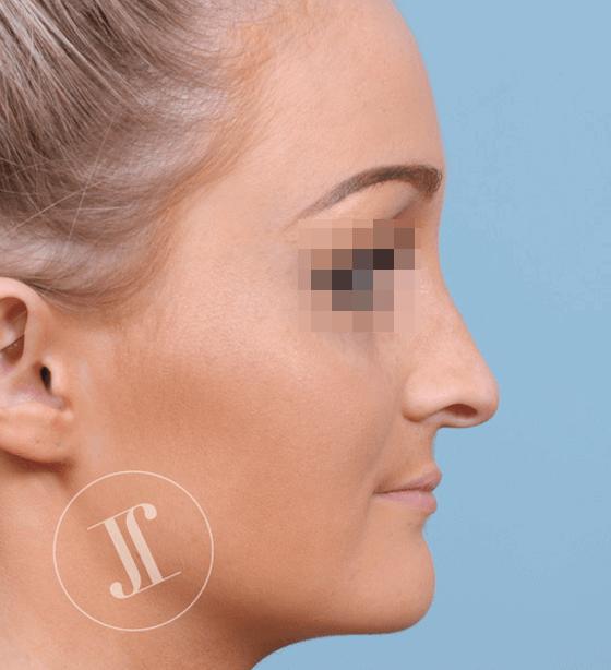 Rhinoplasty Before & After | Julian Rowe-Jones | Guildford, Chelsea ...